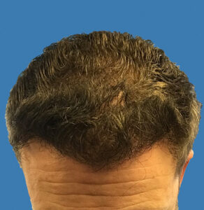 Recovery: Timeline of Hair Growth after NeoGraft - Nashville Hair Doctor