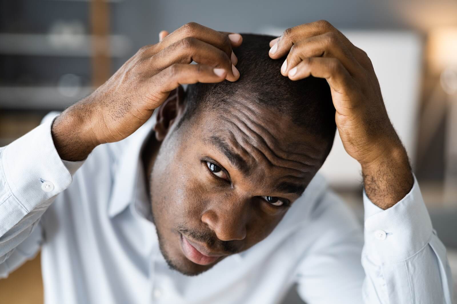 Scalp hair loss store