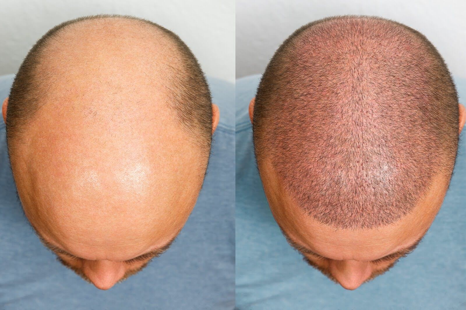 Before-And-After Stories of Successful Hair Restoration - Nashville ...